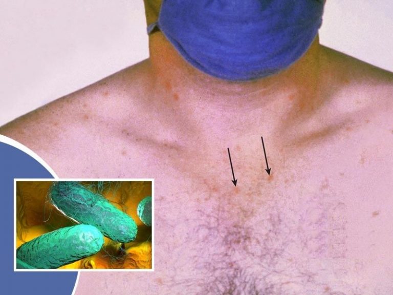 حصبه، تب روده یا تب تیفوئید چیست؟ - درمانکده