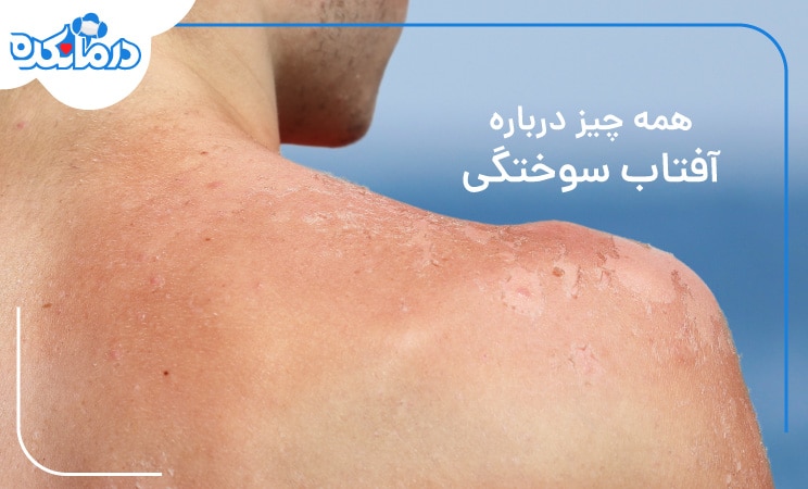 آفتاب سوختگی؛ علت، علائم، روش جلوگیری و درمان درمانکده