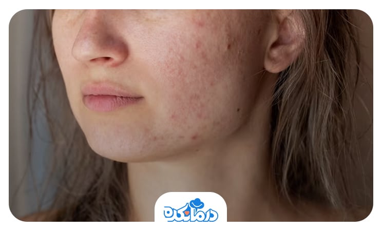 جوش صورت؛ علت، جلوگیری، درمان، انواع، ماسک برای جوش